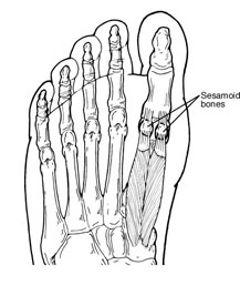 Sesamoid Injuries in the Foot - Campbell, CA Foot Doctor